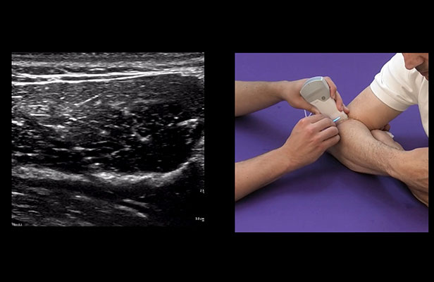 Acupuncture en anesthésie-réanimation guidée par l’échographie | GE ...